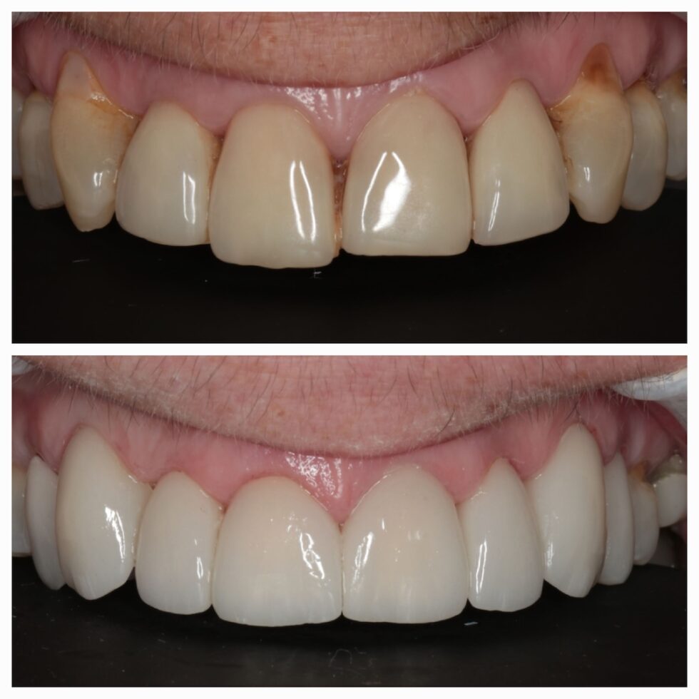 Emax Porcelain Veneers or Composite Veneers | Inspire Dental Care